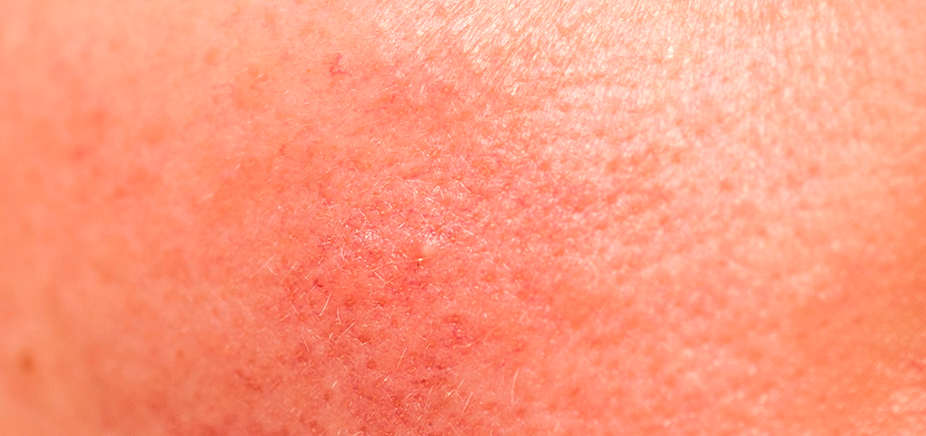 Cuperosis y Rosácea | Tratamientos Faciales | SECRETS